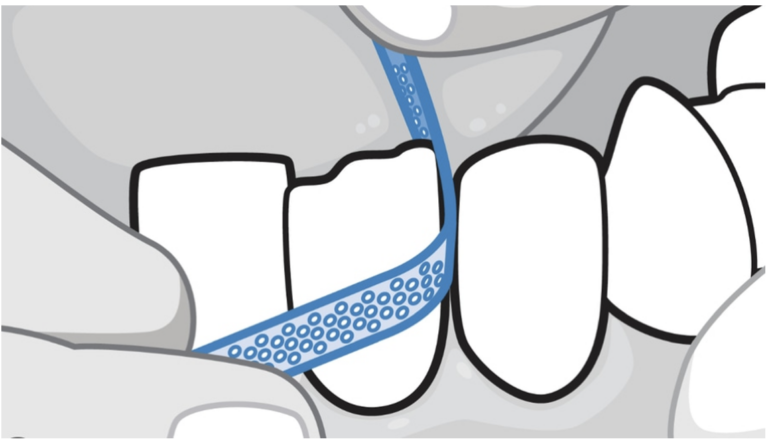 What is Interproximal Reduction (IPR)? - Toothfairy