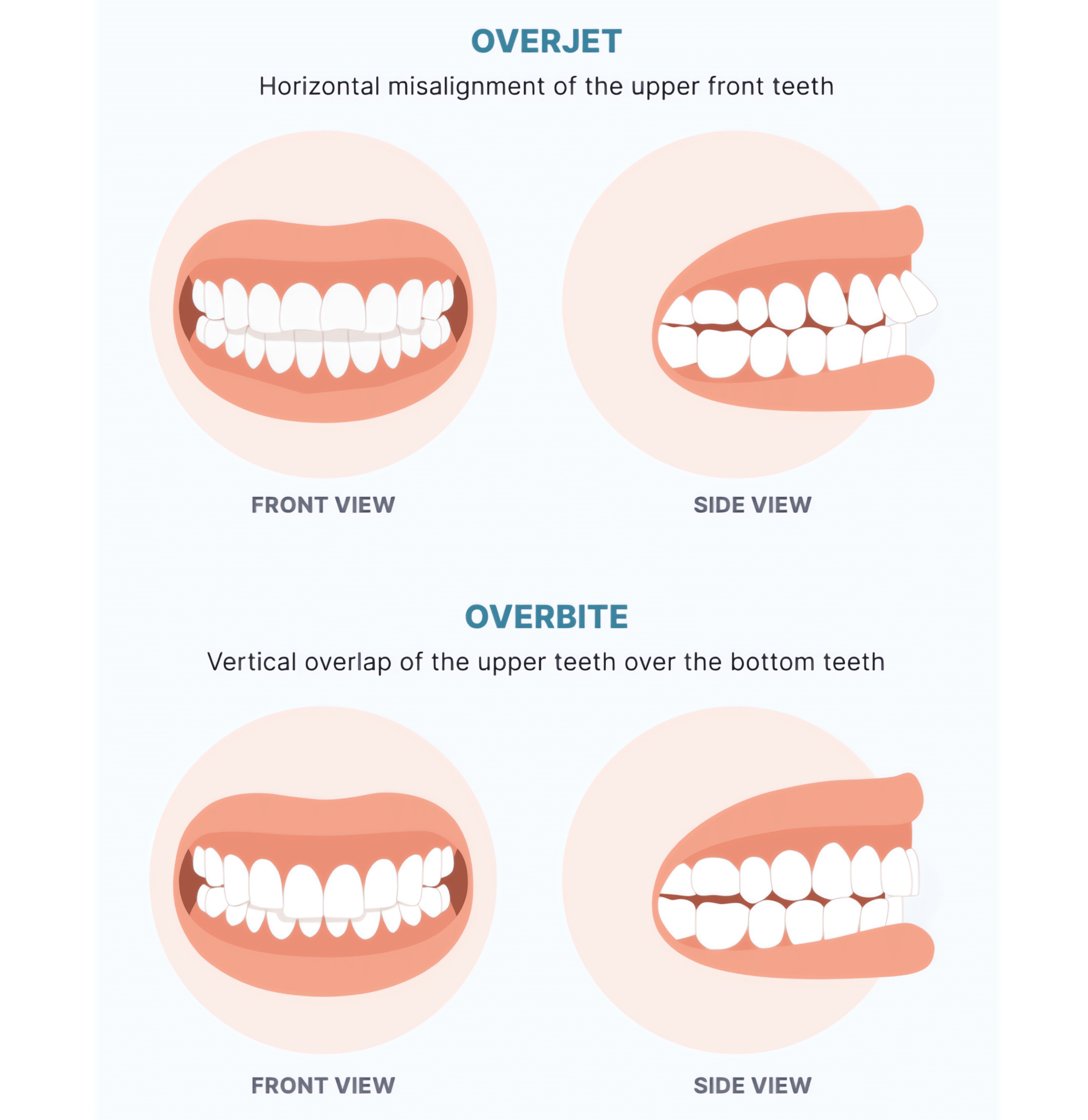 Overjet and Overbite: What’s the Difference? - Toothfairy