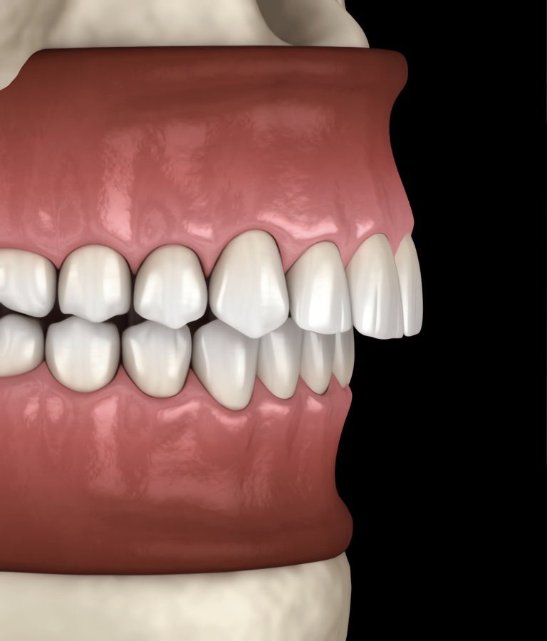 Overjet and Overbite: What’s the Difference? - Toothfairy