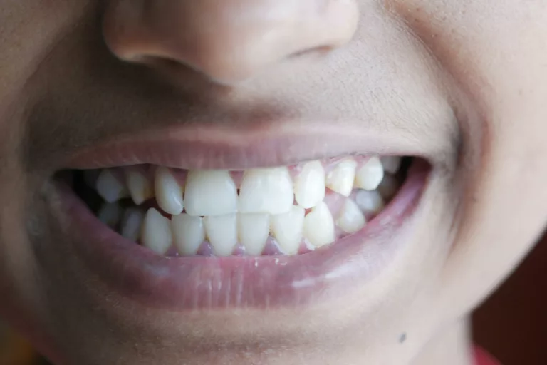 Understanding Black Triangle Teeth | Toothfairy